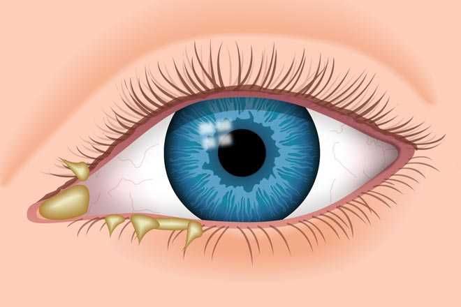 Sticky Eye Discharge in Children : Dr. Suhas Sodal MBBS MD